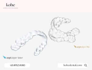 Angel Aligner Select vs Angel Aligner Pro • kohe™ Dental