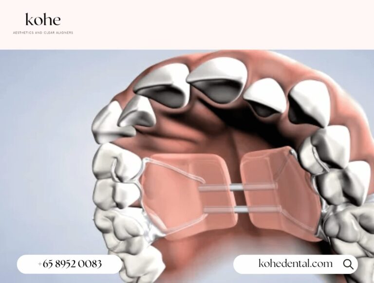 Invisalign Palatal Expanders (IPE): What Are They And How Do They Work ...