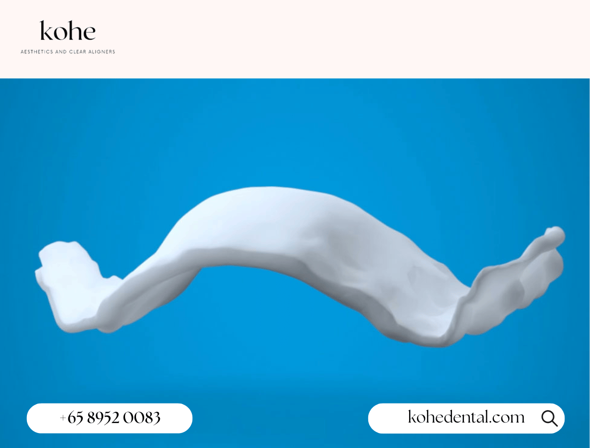 Invisalign Palatal Expanders (IPE): What Are They And How Do They Work ...