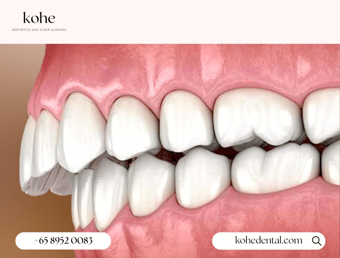 Overjet (Buck Teeth): What It Is & Treatment • kohe™ Dental