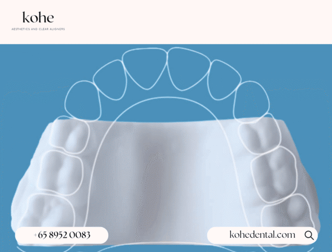 12 Things To Expect With The Invisalign Palatal Expander • kohe™ Dental