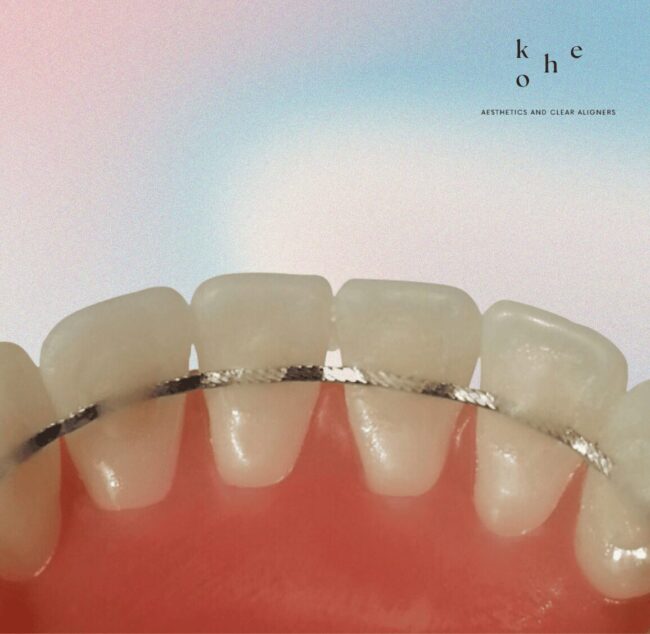 Metal Retainers: Secure Retainers From $225 • kohe™ Dental