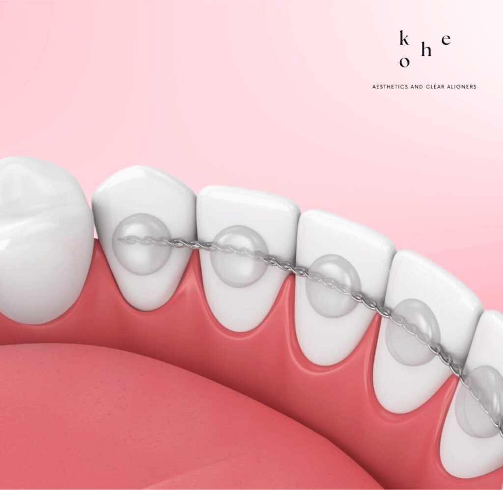 Metal Retainers: Secure Retainers From $225 • kohe™ Dental