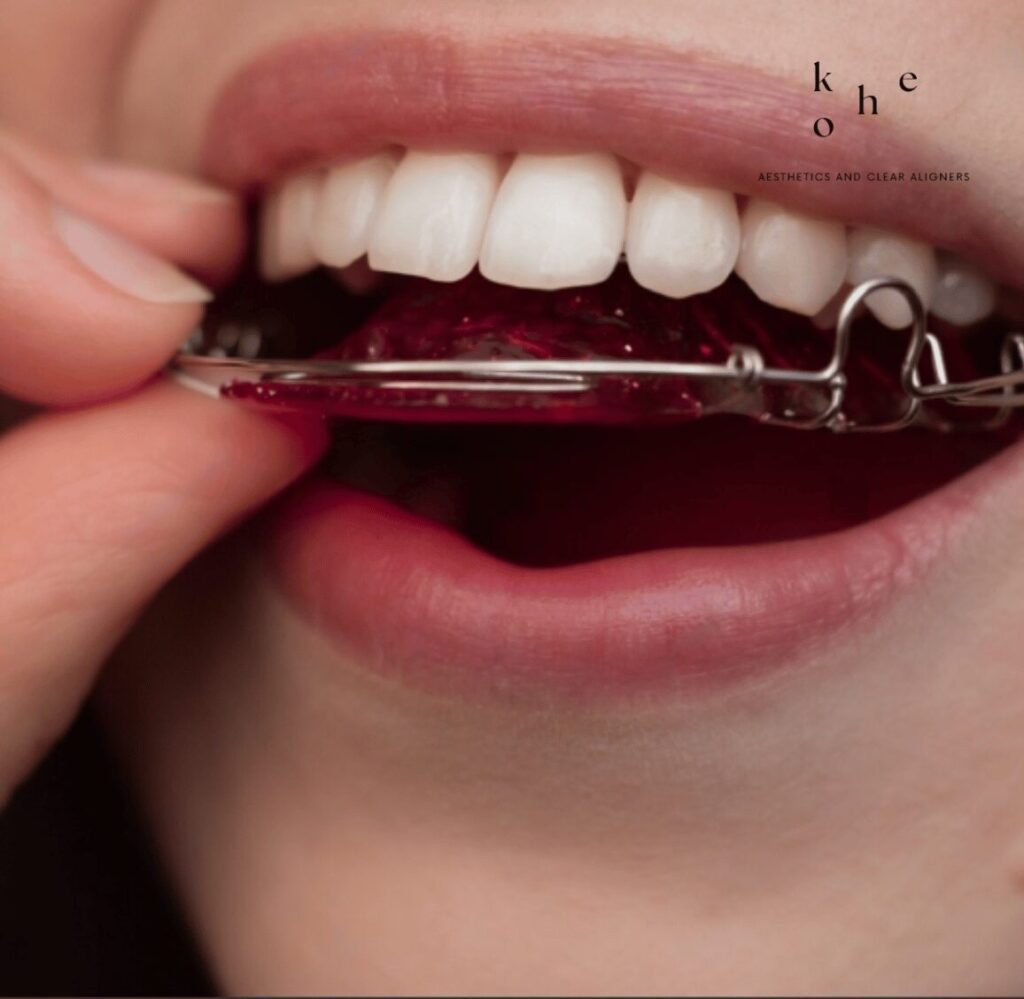 Metal Retainers: Secure Retainers From $225 • kohe™ Dental