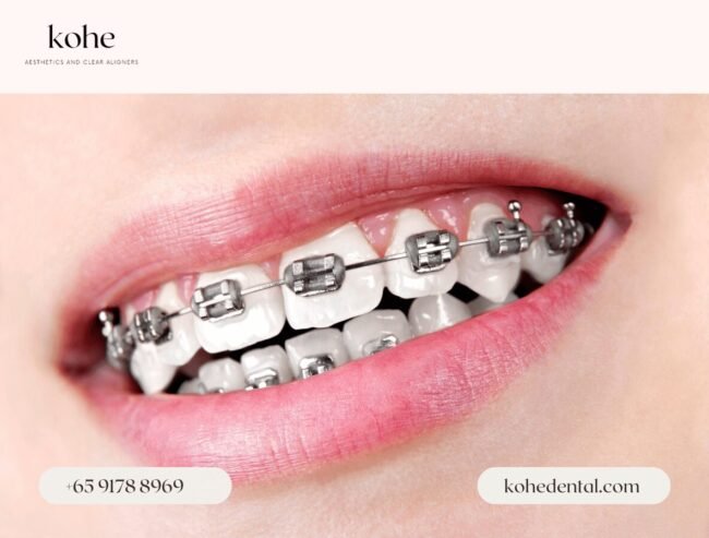 Metal Braces: Teeth Straightening Fr $2,900 • kohe™ Dental