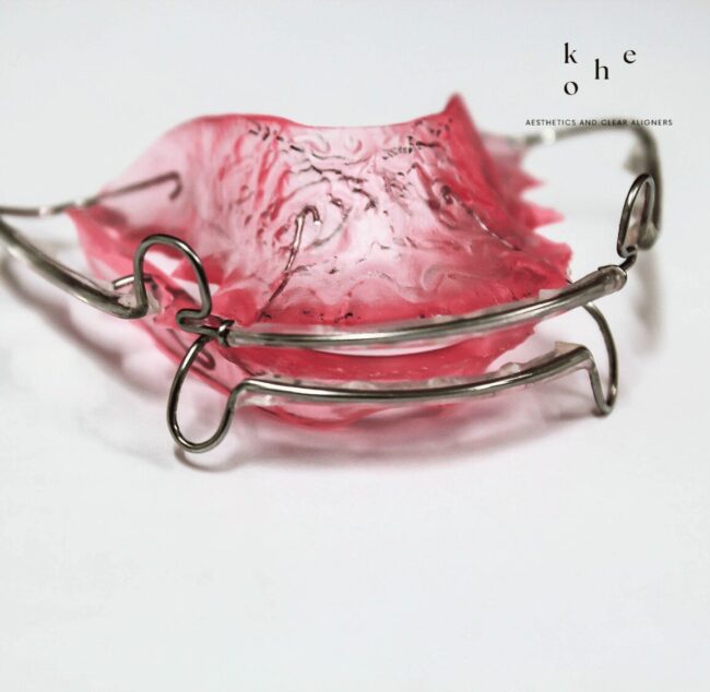 Metal Retainers: Secure Retainers From $225 • kohe™ Dental