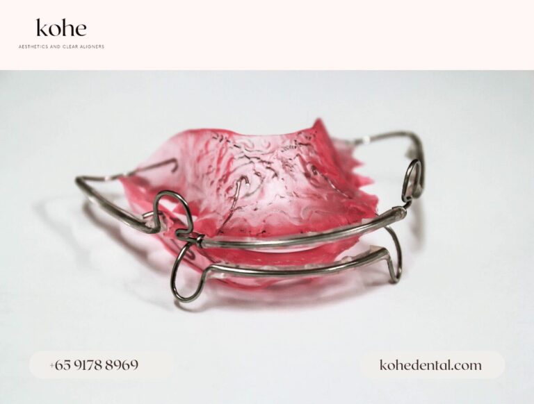 Metal Retainers: Secure Retainers From $225 • kohe™ Dental