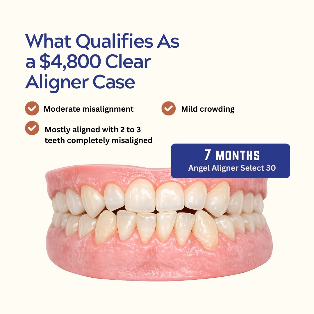 Angel Aligner: Invisalign Alternative Fr $2,000 • kohe™ Dental